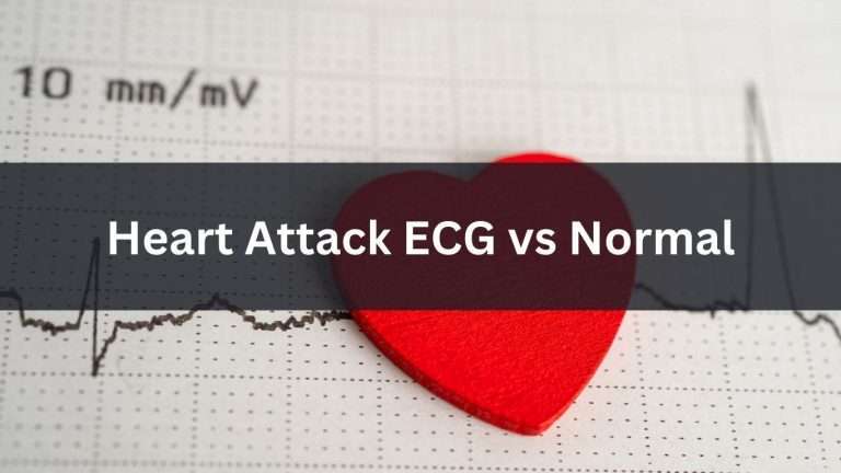Heart Attack ECG vs Normal: Unveiling the Shocking Differences