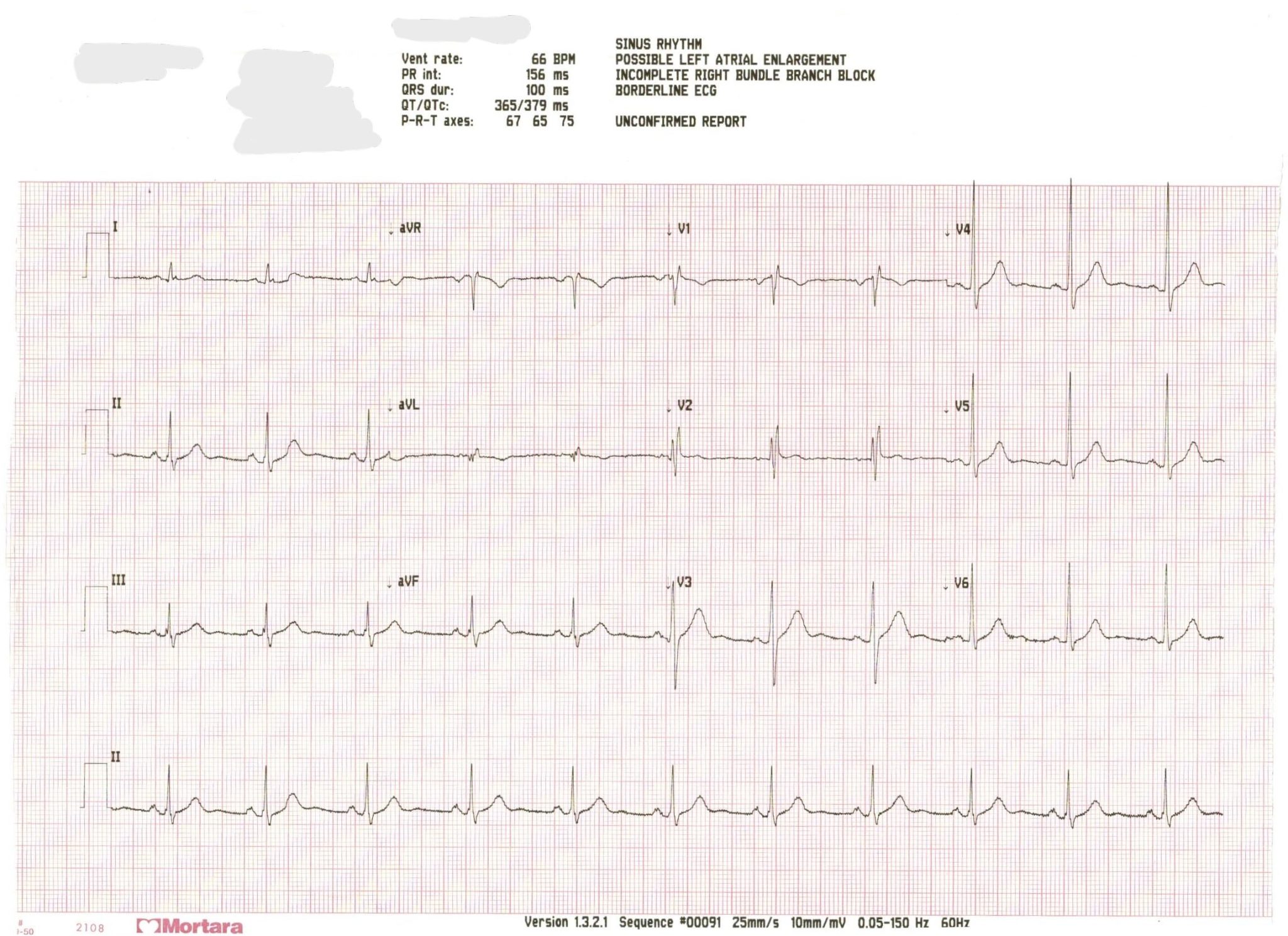 Possible Left Atrial Enlargement Borderline ECG: Risks & Tips